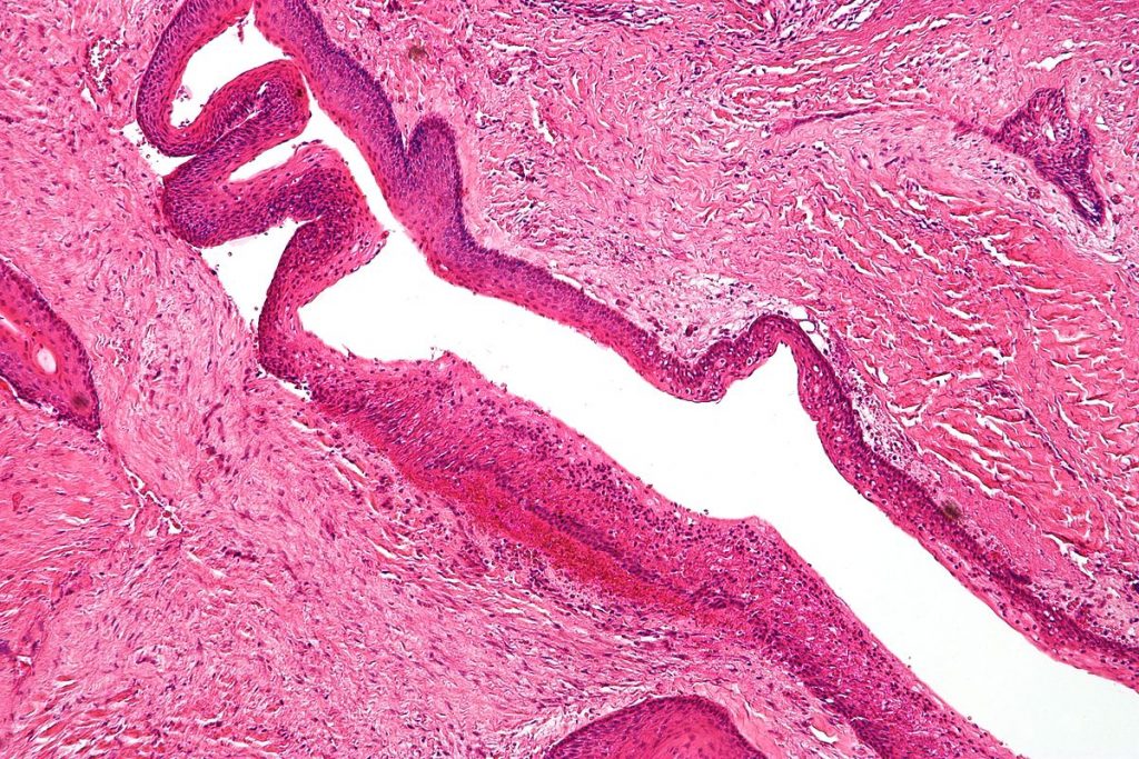 Basalioma (basal cell carcinoma)