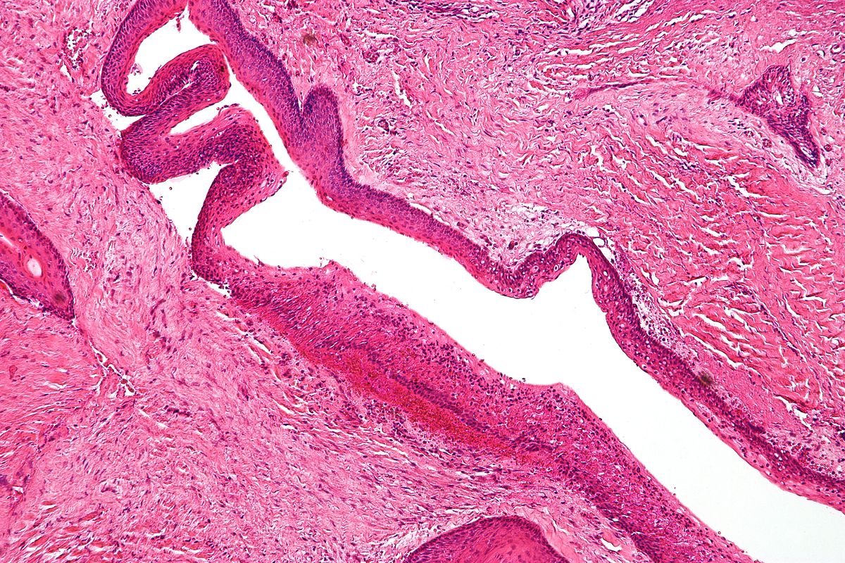 Basalioma (basal cell carcinoma)