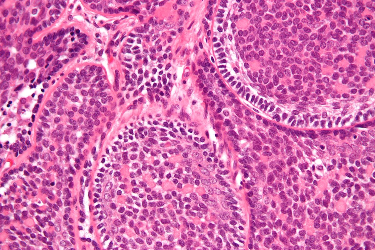 Basalioma (basal cell carcinoma)