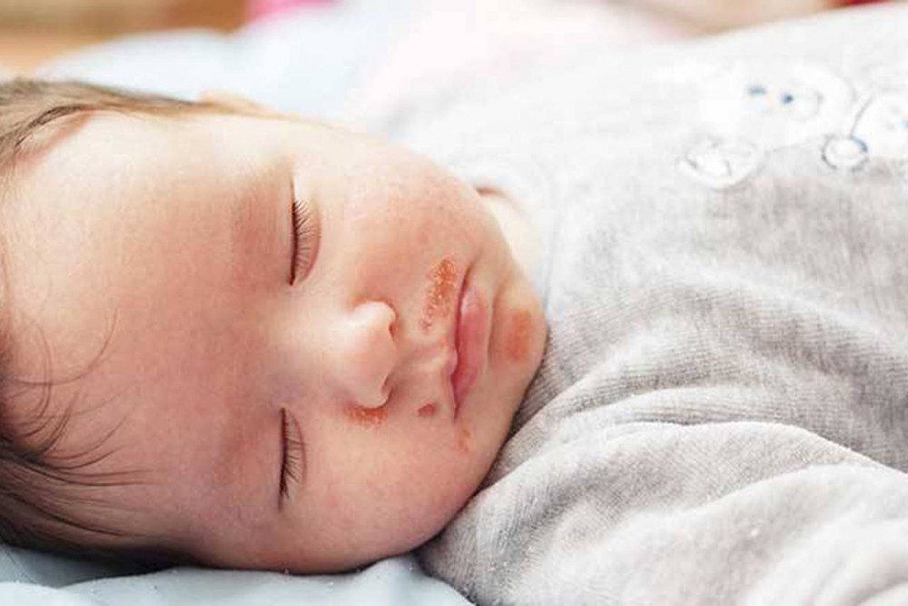 Streptoderma: causes, symptoms, diagnosis and treatment